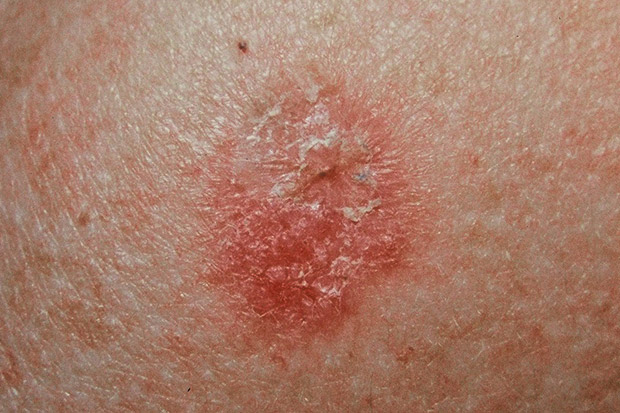 Gallery: Signs of skin cancer | Globalnews.ca