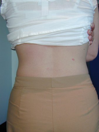 Gallery: Signs of skin cancer | Globalnews.ca