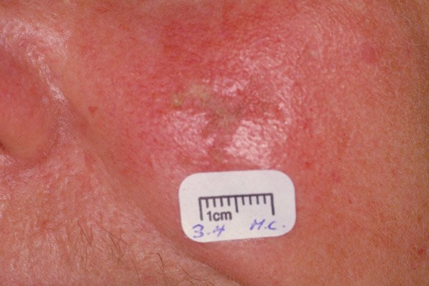 Gallery: Signs of skin cancer | Globalnews.ca