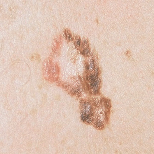 Gallery: Signs of skin cancer | Globalnews.ca