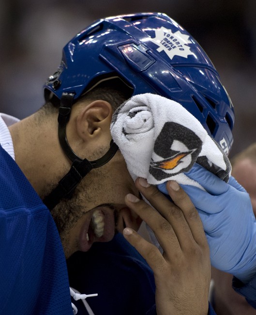 Leafs defenceman Mark Fraser thankful his head injury wasn’t more ...