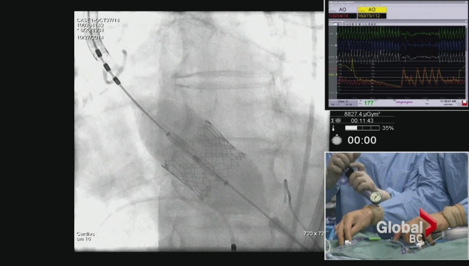 Vancouver heart procedure set for international trial | Globalnews.ca