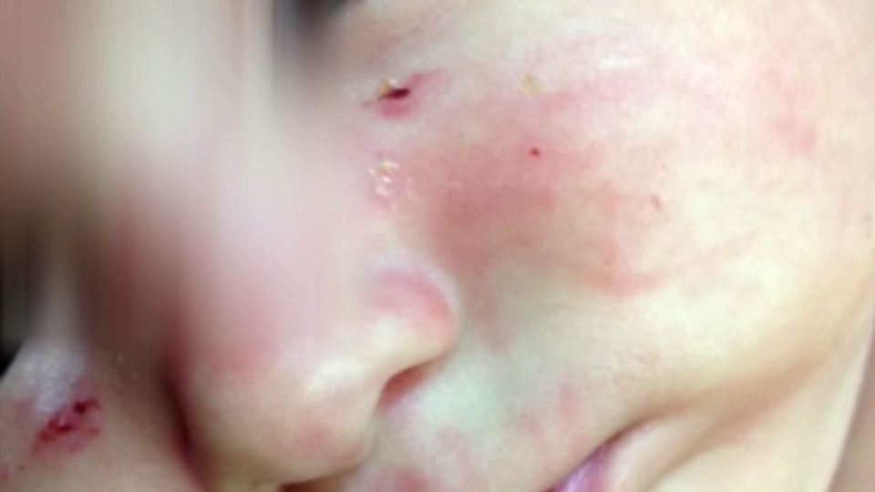 texas-infant-bitten-27-times-by-another-child-unlicensed-home-daycare