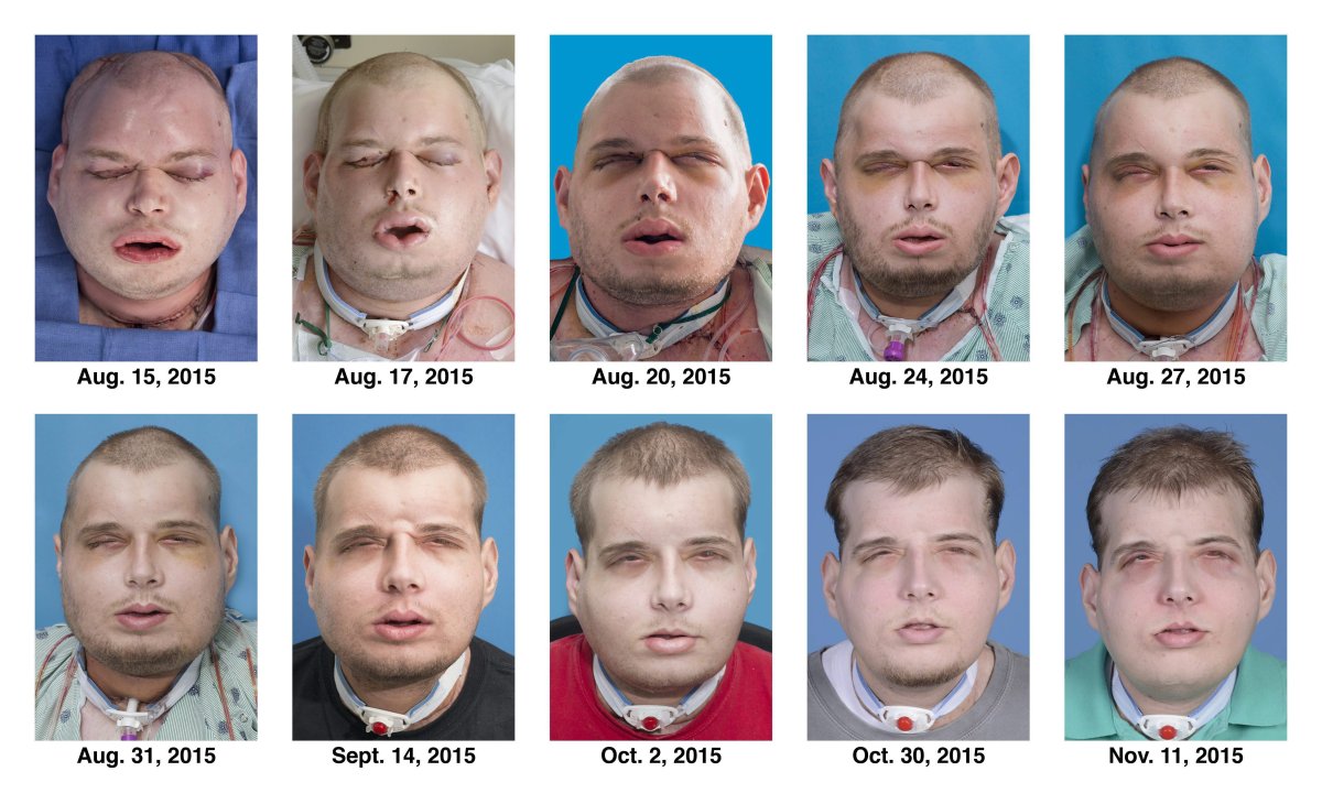 Burned firefighter feeling normal again 1-year after rare face ...