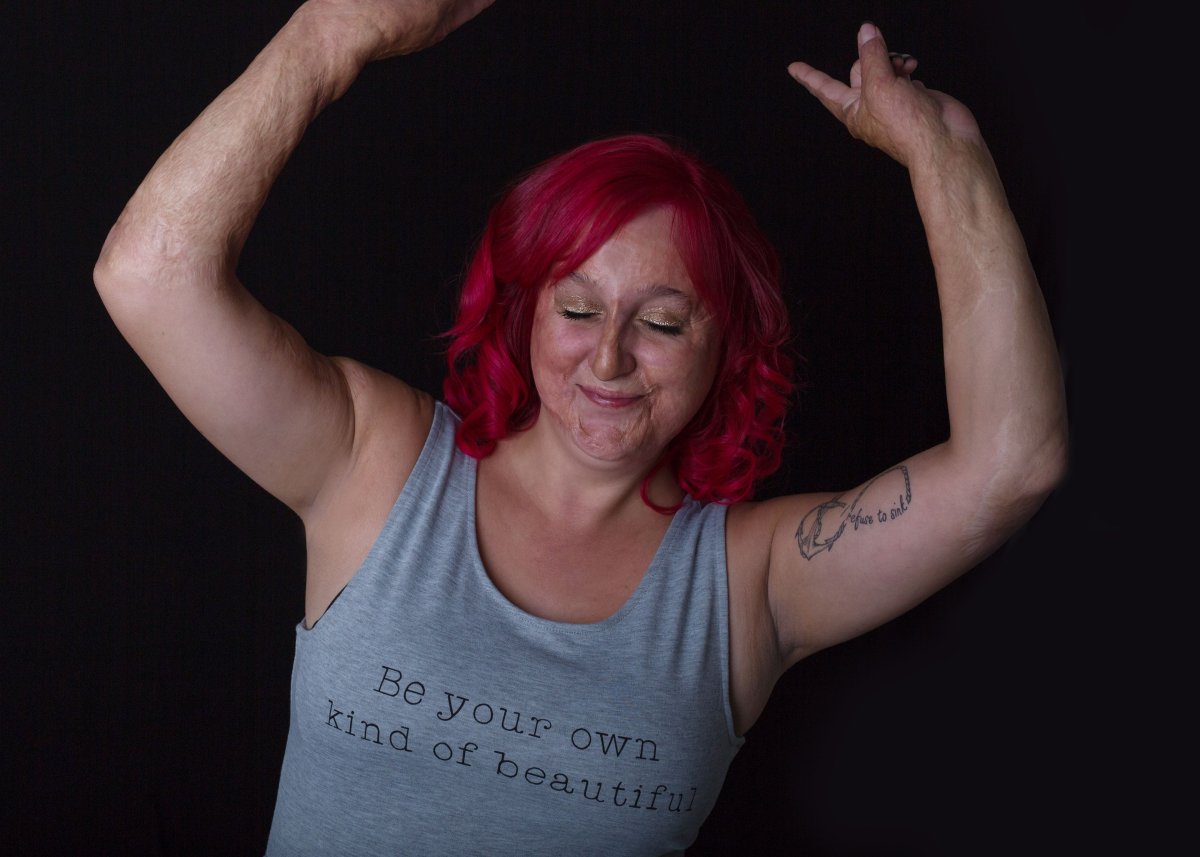 Alberta photography project highlights beauty in scars | Globalnews.ca