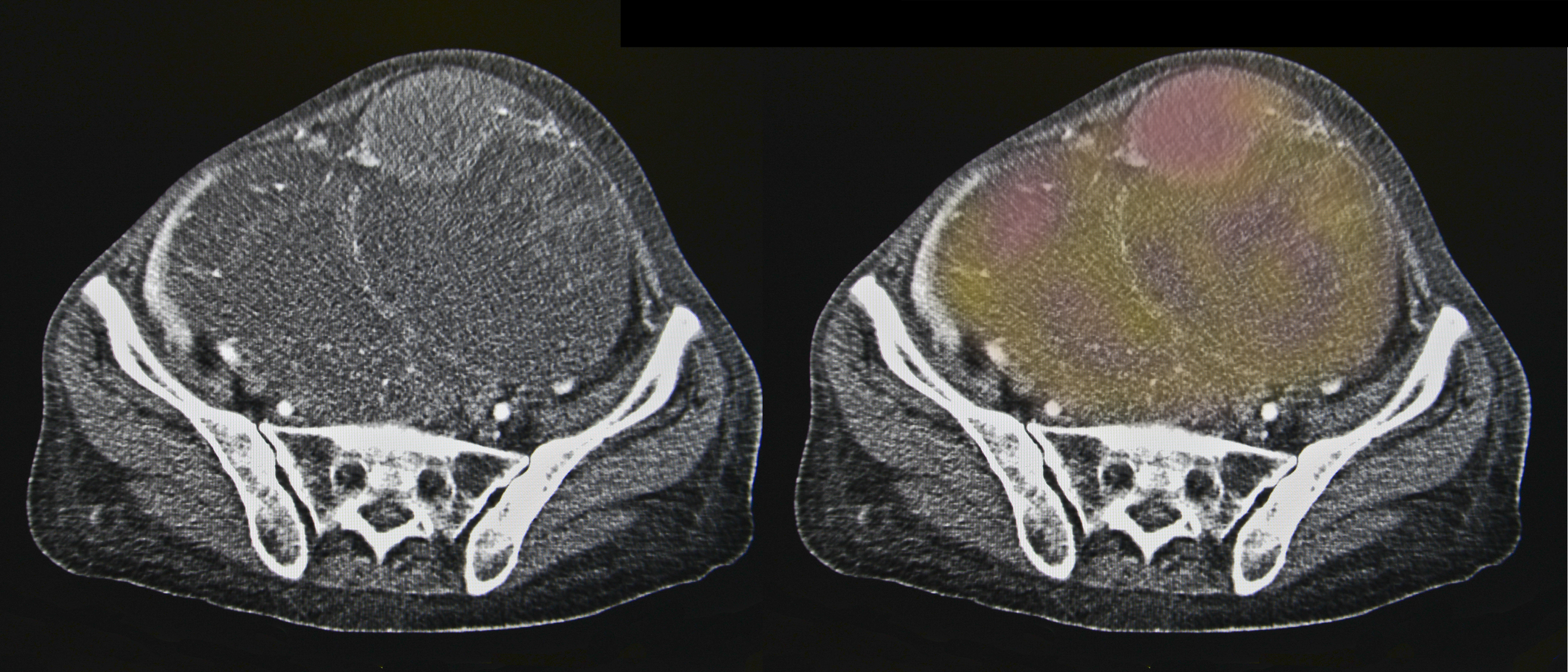 LHSC Foundation receives $5M donation to support ovarian cancer ...