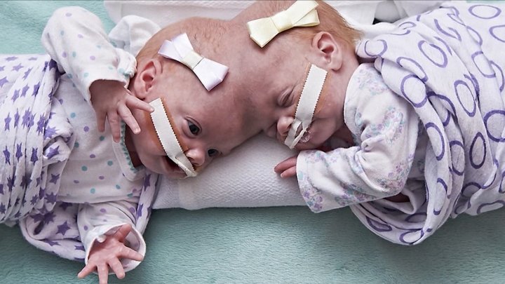 Conjoined Twins Erin And Abby | News, Videos & Articles