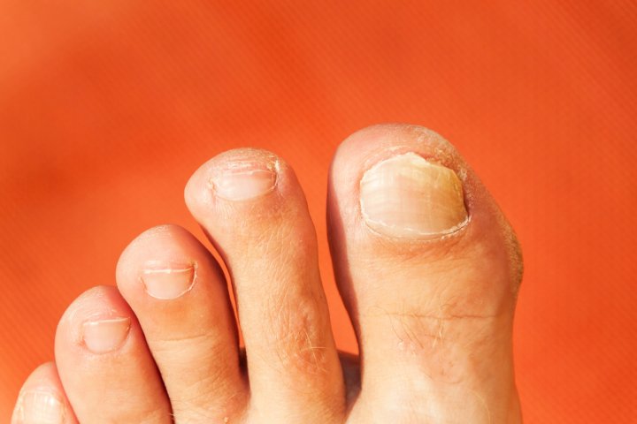 How to deal with toe fungus (and other common summer foot problems ...