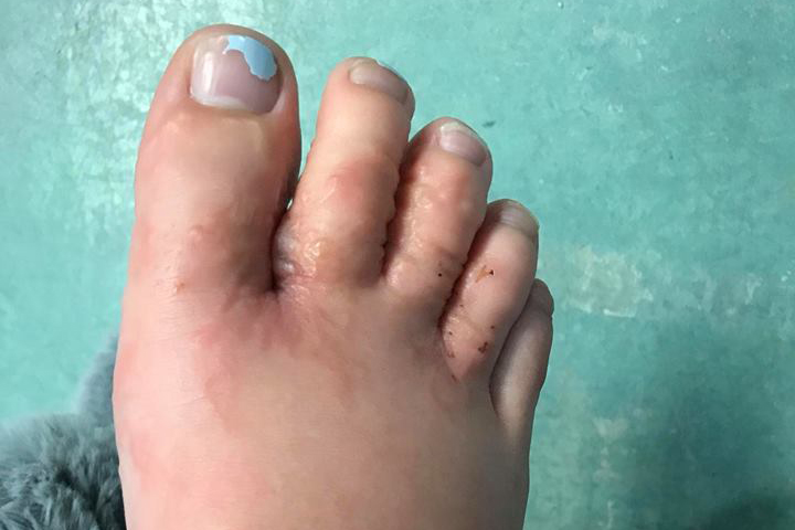 Ontario couple contract parasitic foot infection after Caribbean ...
