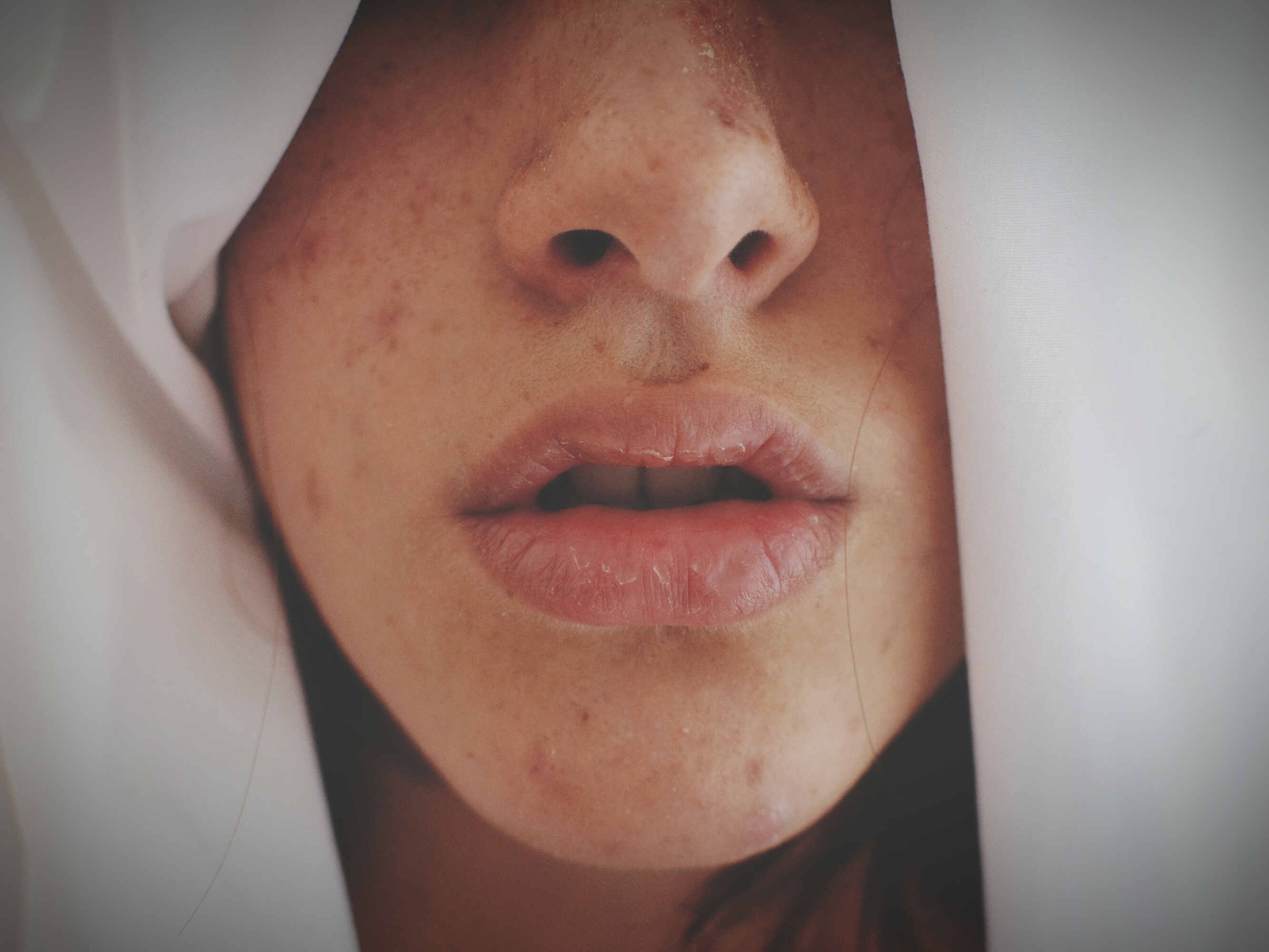 Will the keto diet cause your skin to break out? - National | Globalnews.ca