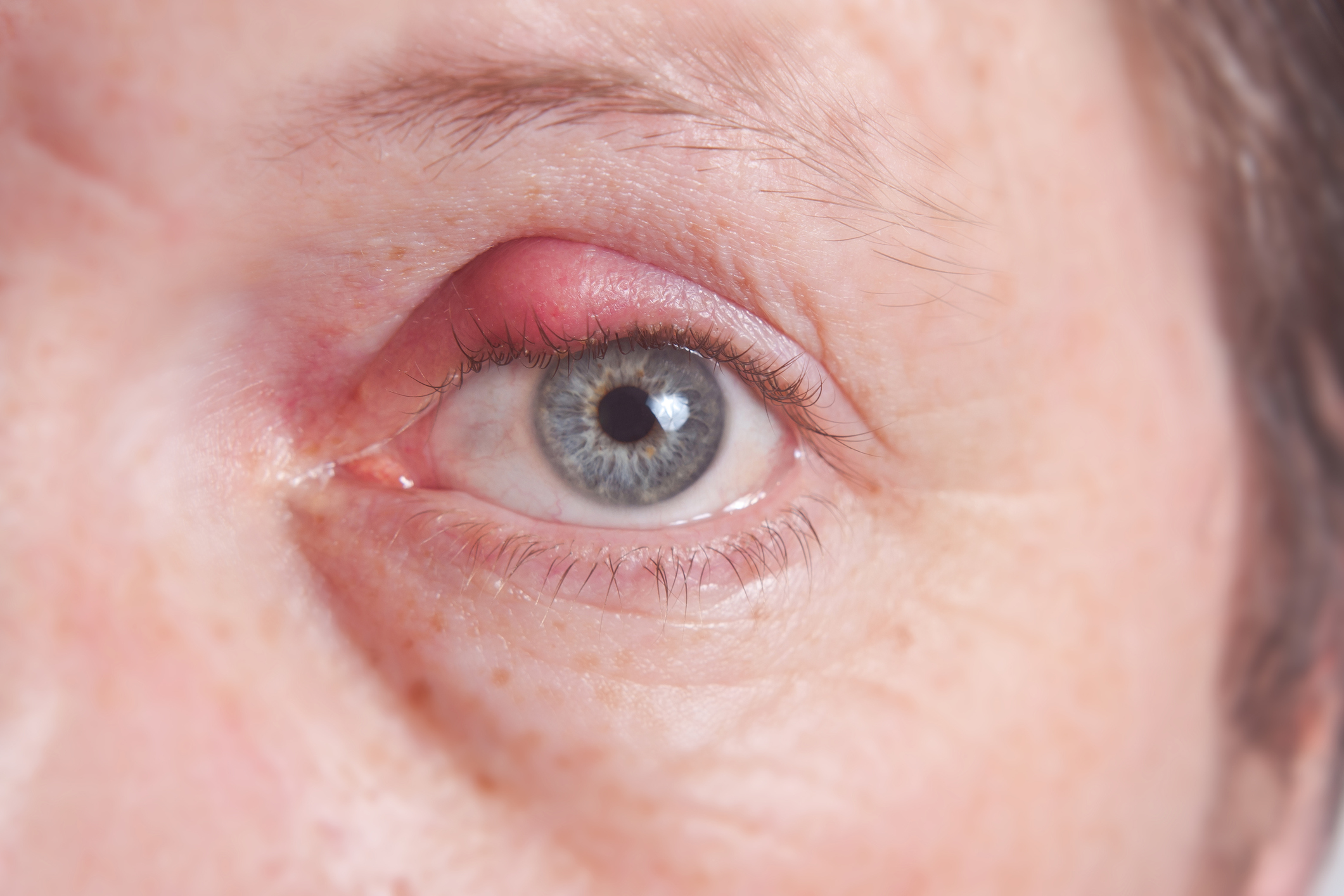 What are styes? The common eye infection that looks like a pimple ...