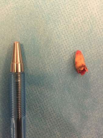 Man’s nose was stuffy because he had a tooth growing in it - National ...