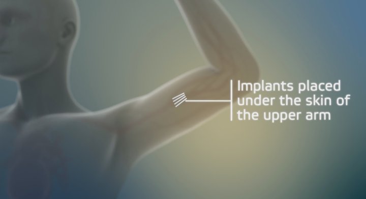 New opioid implant offered to Canadians as potential addiction ...