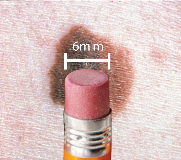 Subtle signs of skin cancer you should never ignore - National ...