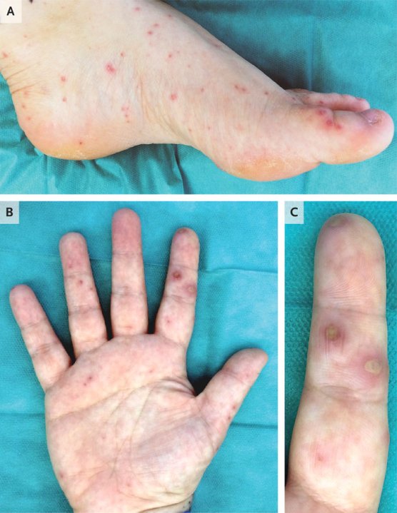 Woman catches ‘rat-bite fever’ from pet rat, develops serious rash ...