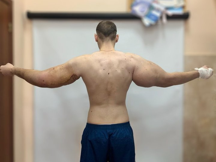 ‘Popeye’ has 3 pounds of dead muscle removed after botched bodybuilding ...