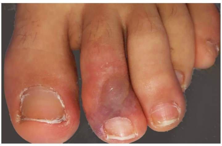 ‘COVID toes’ could be another symptom of coronavirus infection: experts ...