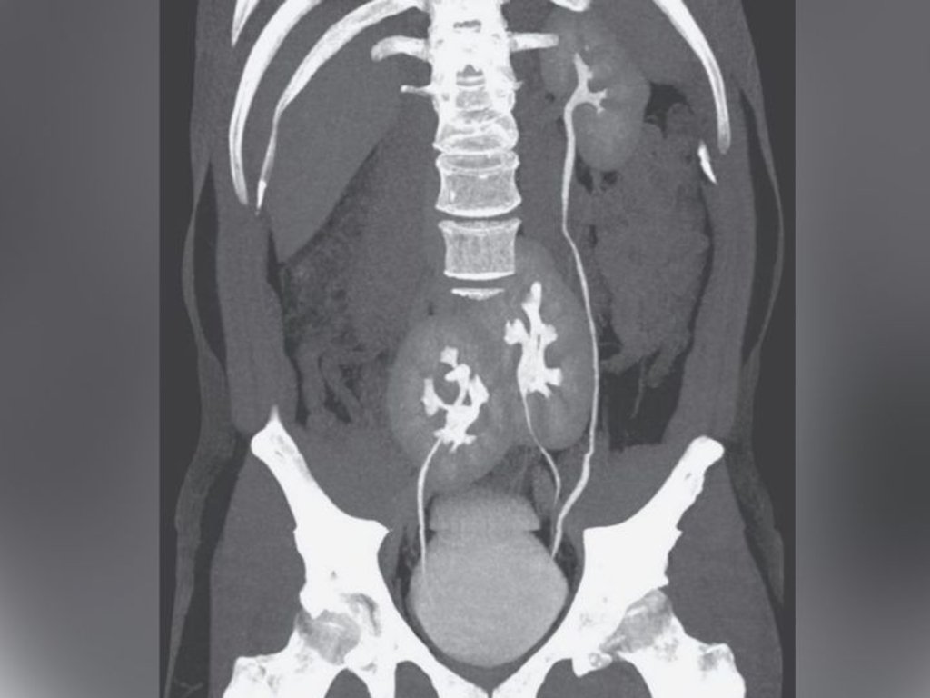 Man discovers he has 3 kidneys after going to doctor for lower back ...