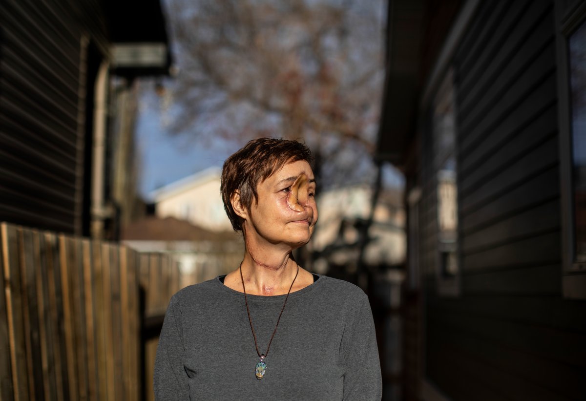 Woman whose cancer surgery in Alberta was delayed says she’s worse off ...