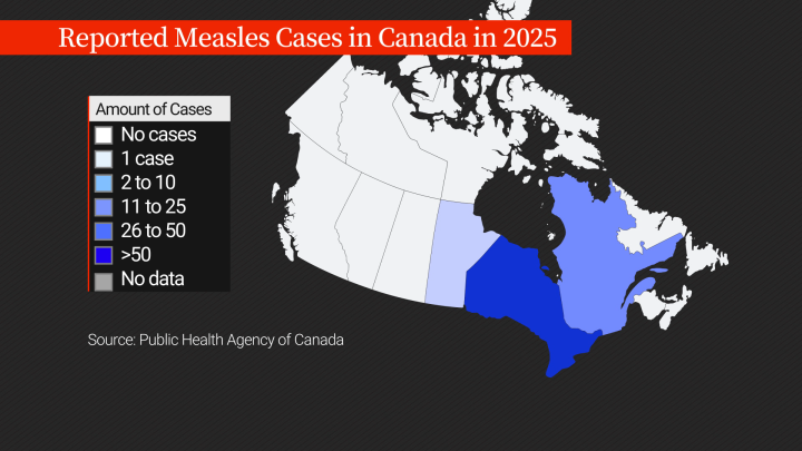 Measles is making a comeback in Canada. What’s driving the surge? - National | Globalnews.ca